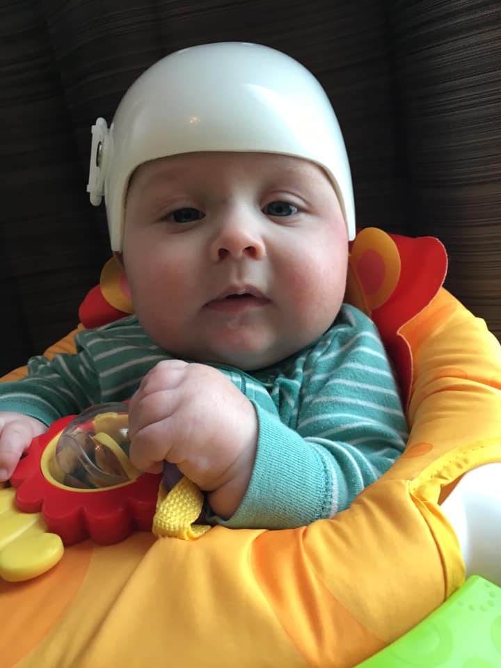 Our Positive Experience with a Pediatric Helmet for our Twin with Plagiocephaly and Torticollis ...